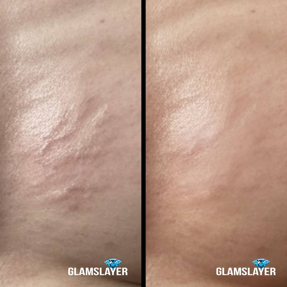 Improve Your Skin with MCA Needling & Scar Revision (UK)